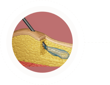 Side Effects & Post-Injection Care | Firmagon® (degarelix for injection)